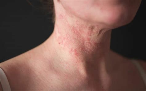 Why Is My Scalp Flaky 7 Tips To Stop Flakes Fast