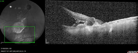 How Do You Manage Subretinal Fluid After Retinal Detachment Haytham