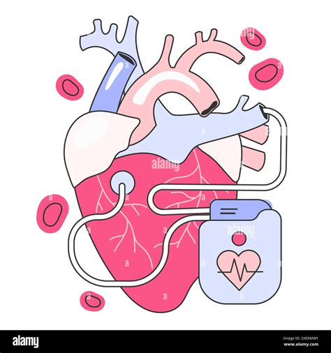 Artificial Cardiac Pacemaker Medical Device That Generates Electrical Impulses Delivered By