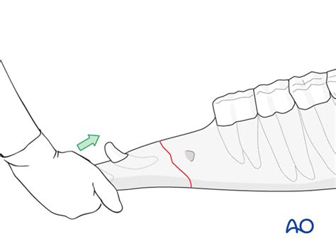 U Shaped Splint For Horizontal Ramus Interdental Space Bilateral Fractures