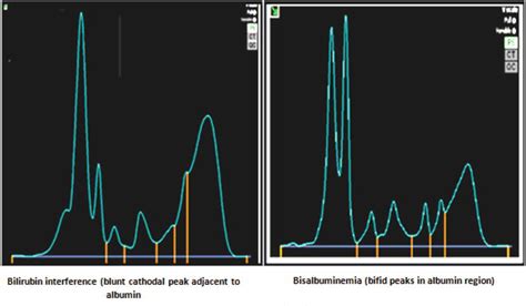 Serum Protein Electrophoresis And Its Clinical Applications Intechopen