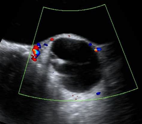 Dermoid Cyst Ultrasound