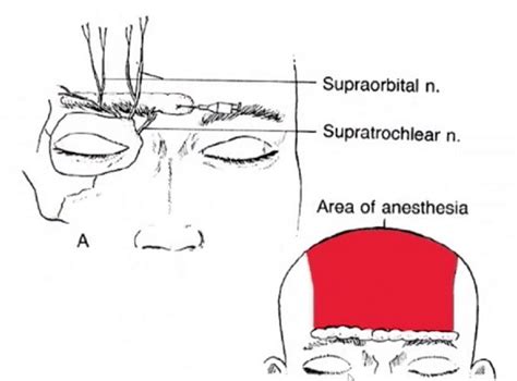Supratrochlear Nerve Block