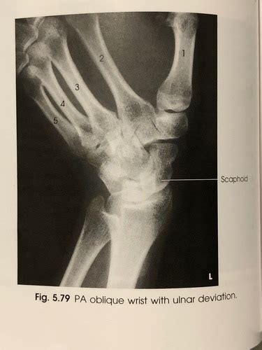 Ulnar Deviation X Ray
