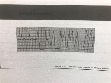 EKG Technical Aspects Artifact Flashcards Quizlet