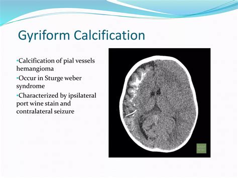 Ct Head Made Easy Pptx