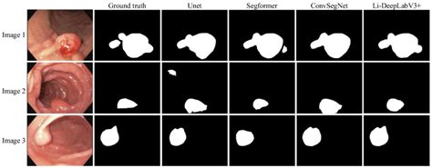 Lightweight Colon Polyp Segmentation Algorithm Based On Improved Deeplabv3 Pmc