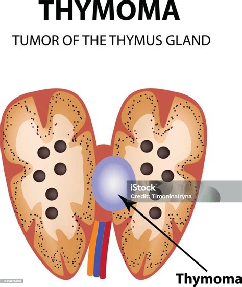 Tumor Kelenjar Thymus Thymoma Apa Yang Terjadi Infografis Ilustrasi