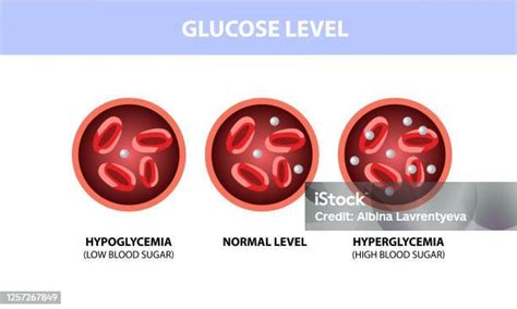 혈당 포도당 검사 당뇨병 인슐린 저혈당 또는 고혈당증 다이어그램 적혈구 및 포도당 당뇨병에 대한 스톡 벡터 아트 및 기타 이미지 당뇨병 차트 건강 검진 Istock