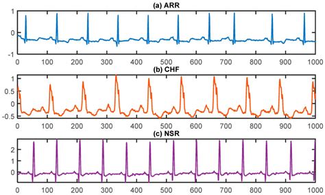 Deep Learning Based Arrhythmia Detection Using Ecg Signals A