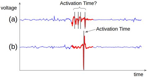 A Electrogram Is Too Complex And Fractionated Making It Difficult To Download Scientific