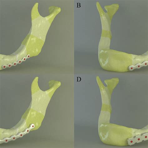 Atrophic Mandible Model With 2 Mm Thick Cortical Bone Cancellous Bone