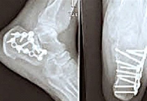 Calcaneus Fractures Dr Warren