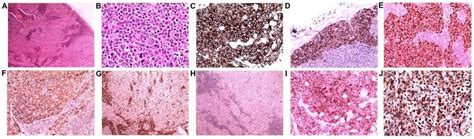 Lymph Node Biopsies Reveal Diffuse And Sinus Proliferation Of Large Download Scientific Diagram