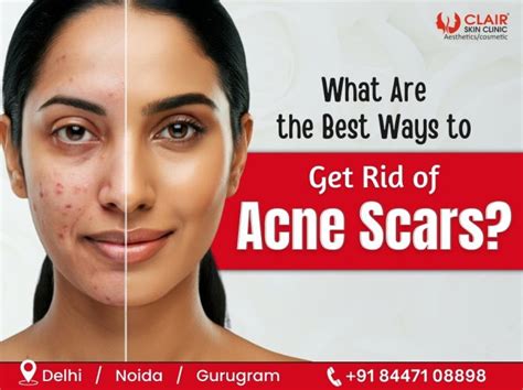 What Are The Best Ways To Get Rid Of Acne Scars Dermatologist In