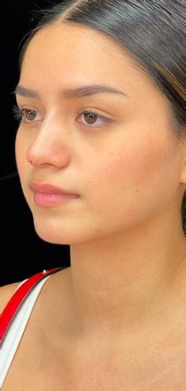 Pdo Threads Before And After Patient 01 Elleve Medspa