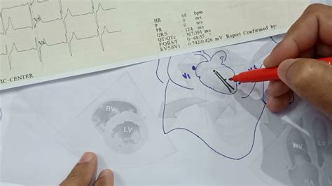 Left Anterior Hemi Block Or Left Anterior Fascicular Block Lbbb Youtube