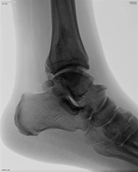 Свободные кости... | Портал радиологов