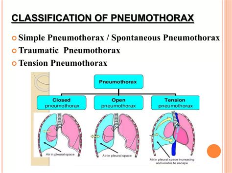 Pneumothorax Pptx
