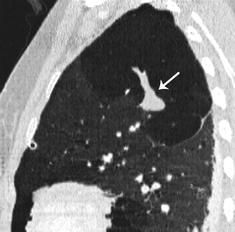 Segmental Bronchial Atresia