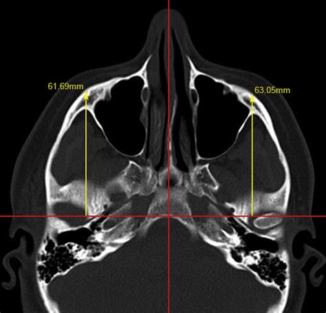 Symmetry Evaluation Of The Malar Eminence Using An Axial Computed
