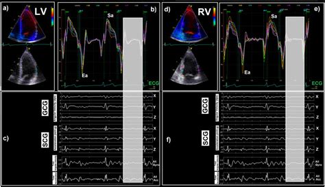 Quiescent Phase Identification On Mems Signals With Parallel Visual