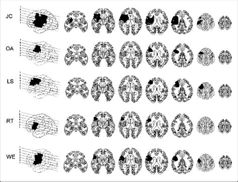 Extent Of Patients Lesions In The Dorsolateral Frontal Cortex Download Scientific Diagram