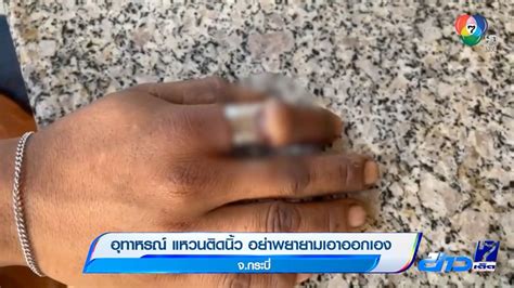 ข่าวอุทาหรณ์ แหวนติดนิ้ว พยายามเอาออกเอง สุดท้ายนิ้วบวม เริ่มเน่า