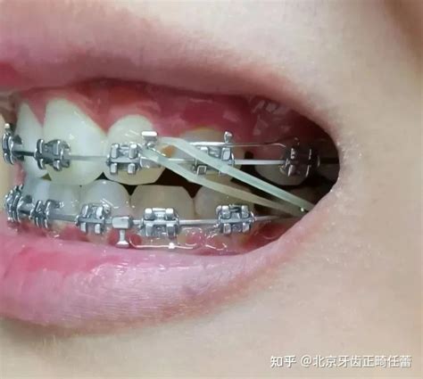 牙齿矫正为什么要挂橡皮筋都必须要挂吗 知乎