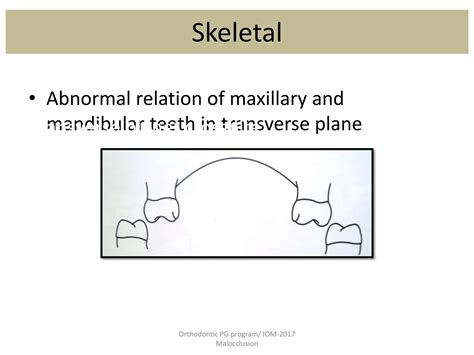 Classification Of Malocclusionpptx
