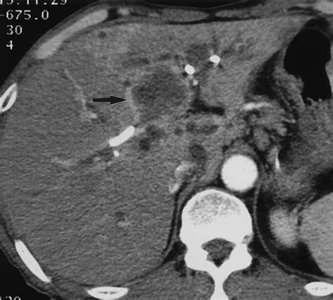 Cholangiocarcinoma Pictorial Essay Of Ct And Cholangiographic Findings Radiographics