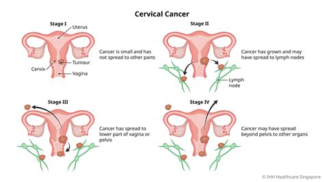 Cervical Cancer Stages