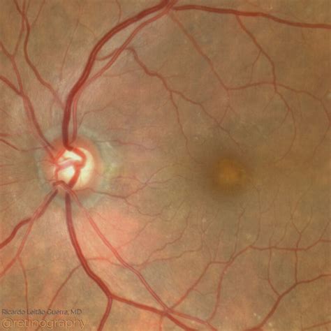 Acquired Vitelliform Lesion Ricardo Leitão Guerra