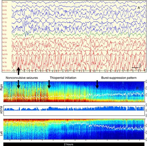 Colour Density Spectral Array Of Bilateral Bispectral Index In Status Epilepticus Anales De