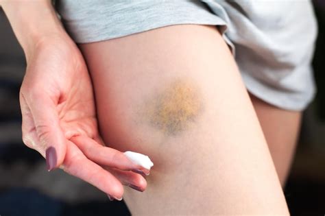 Premium Photo A Young Woman Applies A Healing Cream To A Bruise On