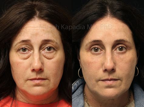 Before And Two Weeks After Upper Blepharoplasty Surgery Boston Eyelid Surgery