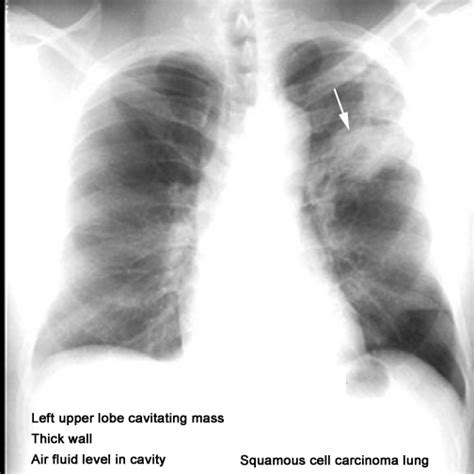 Cavitation Due To Tb