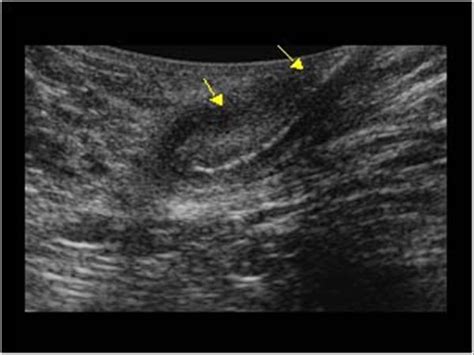 Abdomen And Retroperitoneum 111 Abdominal Wall Case 1116 Various