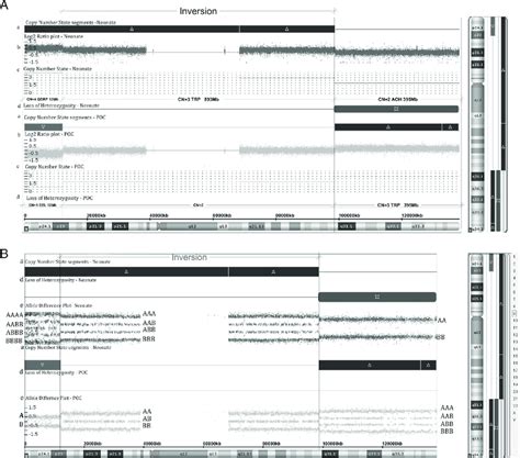 Results Of Snp Microarray Analysis Affymetrix Cytoscan™ Hd Suite With