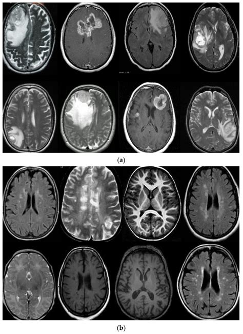 Diagnostics Free Full Text Brain Tumor Detection And Classification On Mr Images By A Deep
