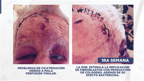 Hyperbaric Oxygen Therapy