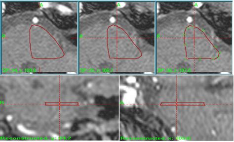 To Define The Critical Structure For A Mimic Trigeminal Neuralgia Case Download Scientific To Define The Critical Structure For A Mimic Trigeminal Neuralgia Case Download Scientific