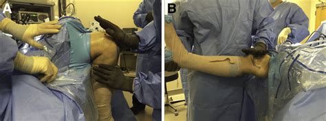 A B An Arthroscopic Debridement Has Been Completed In This Right