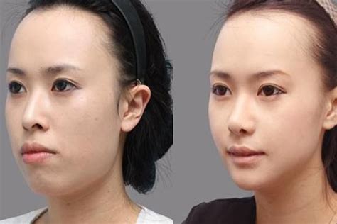 Protruding Jaw Surgery East Rose Dental Clinic