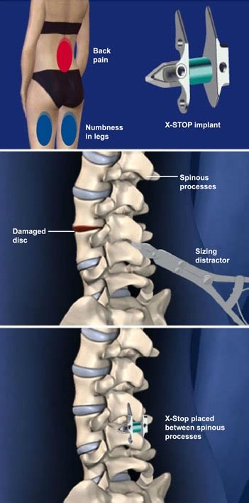 Interspinous Process Decompression — X Stop® The Southeastern Spine Institute