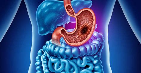 Gist Gastrointestinal Stromal Tumor Summary Symptoms Treatments