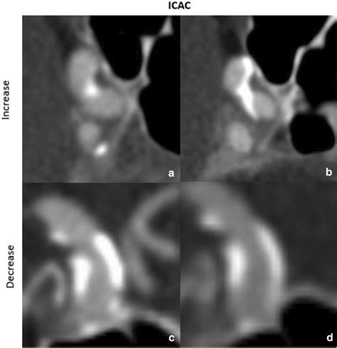 Increase And Decrease Of Intracranial Calcification Volumes At Baseline Download Scientific