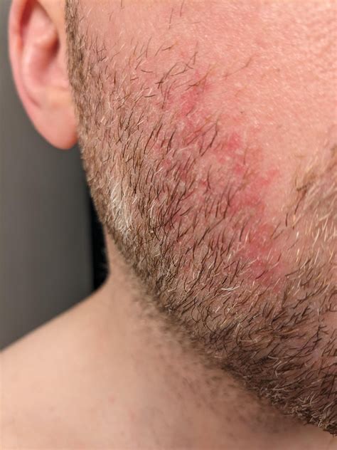 Rash Mostly Under Beard Rdermatologyquestions