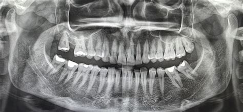 Tmj Temporomandibularjoint Osteoarthritis Radiology Oralradiology