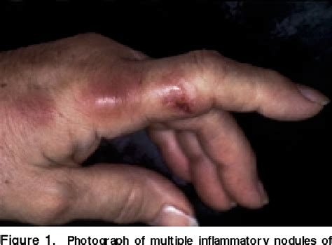Figure 1 From The Clinical Spectrum Of Nodular Lymphangitis Semantic Scholar